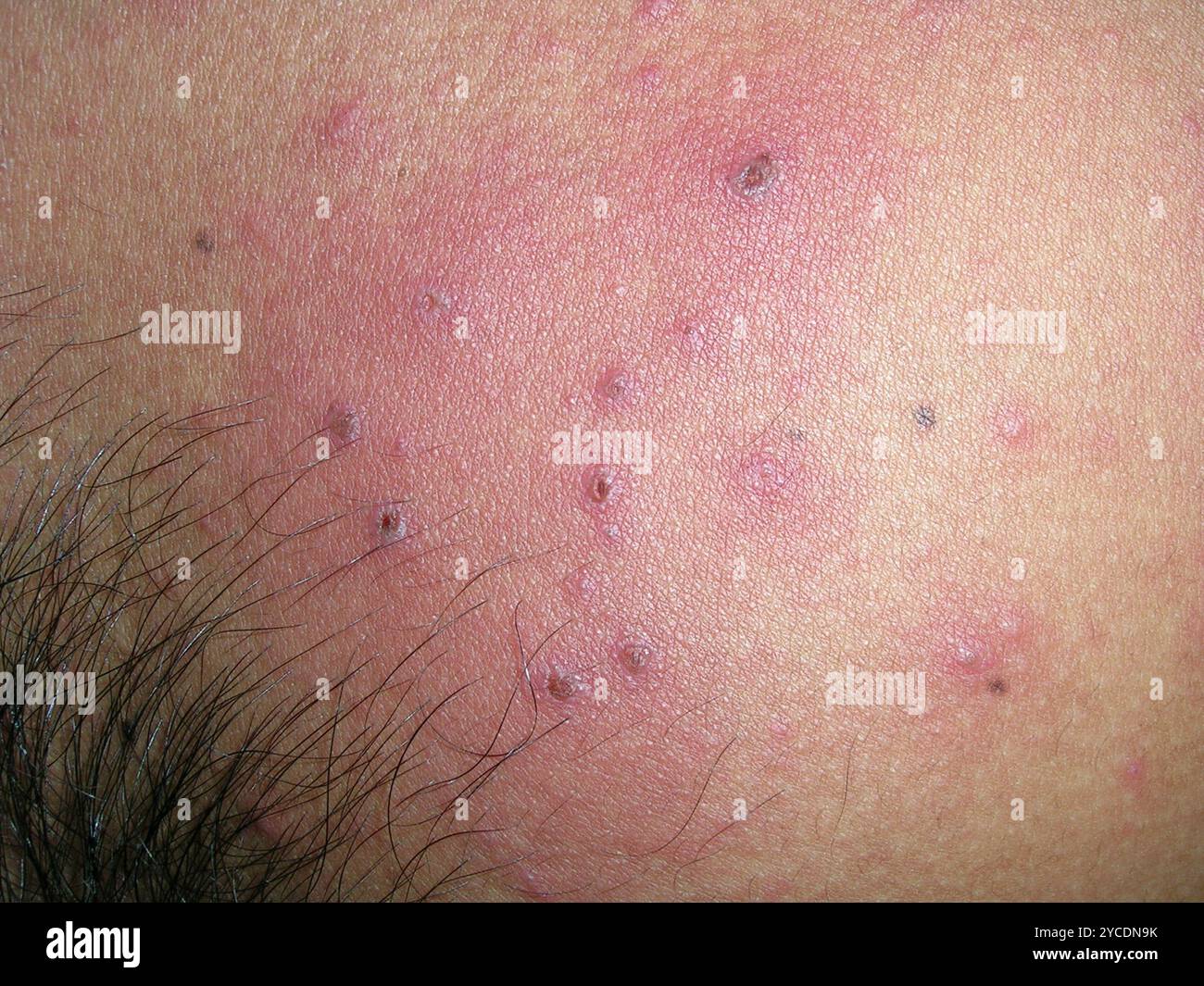 Chickenpox rash on a 27 year old male patient's chest. Chickenpox ...