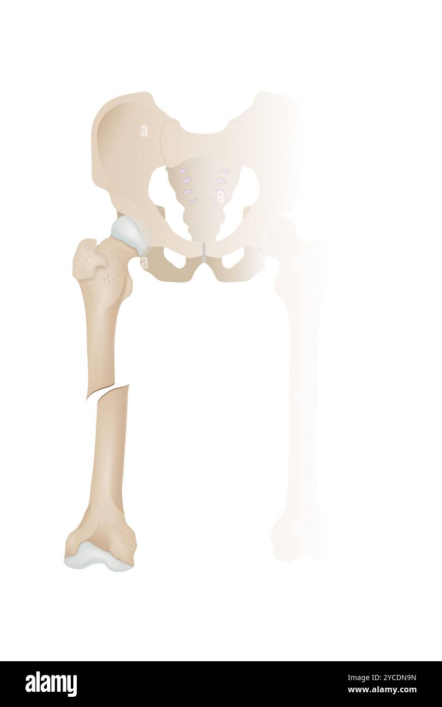 Illustration of a spiral femoral fracture. A twisting force to the ...