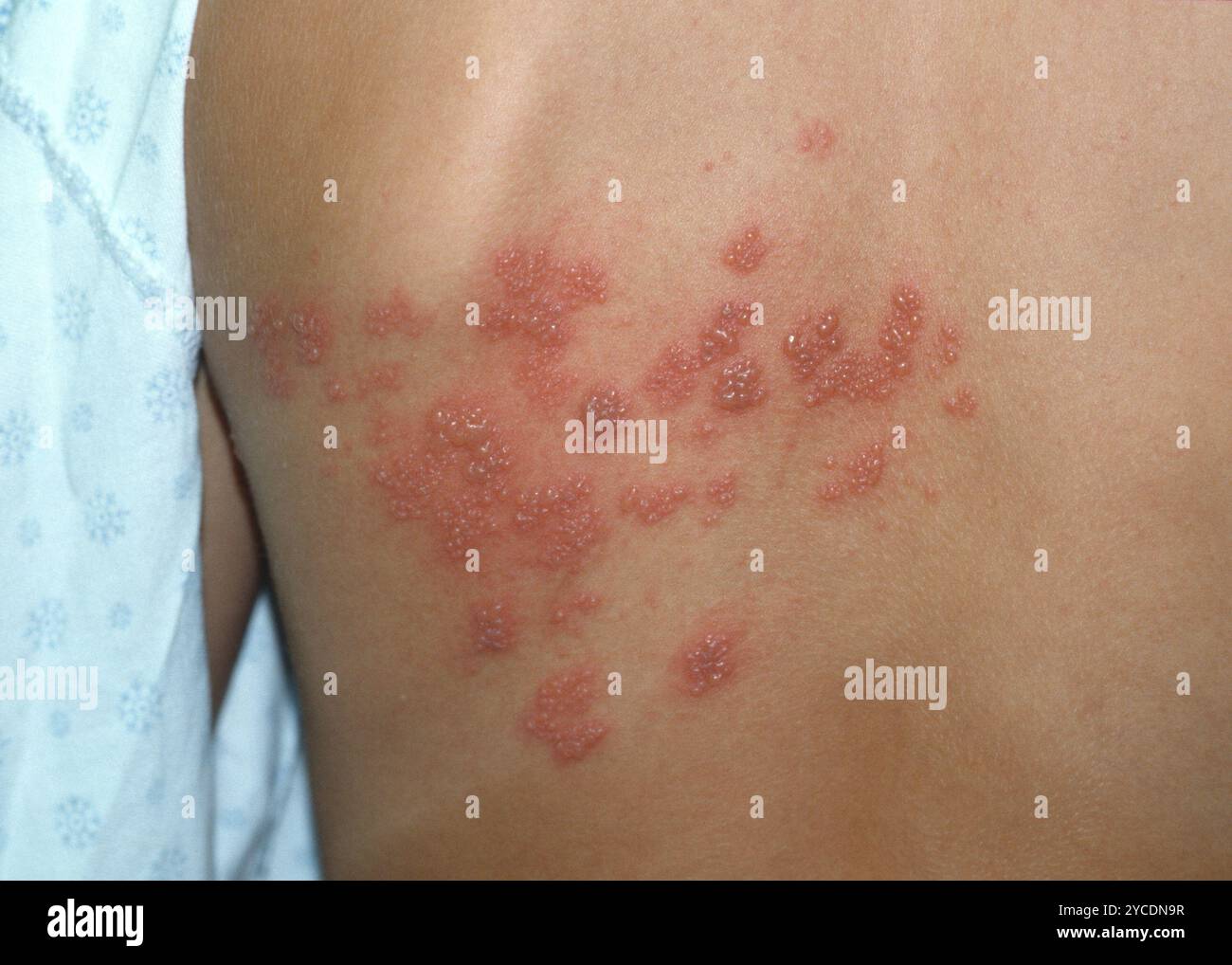 Shingles, or herpes zoster, rash on a patient's back. Shingles is a ...