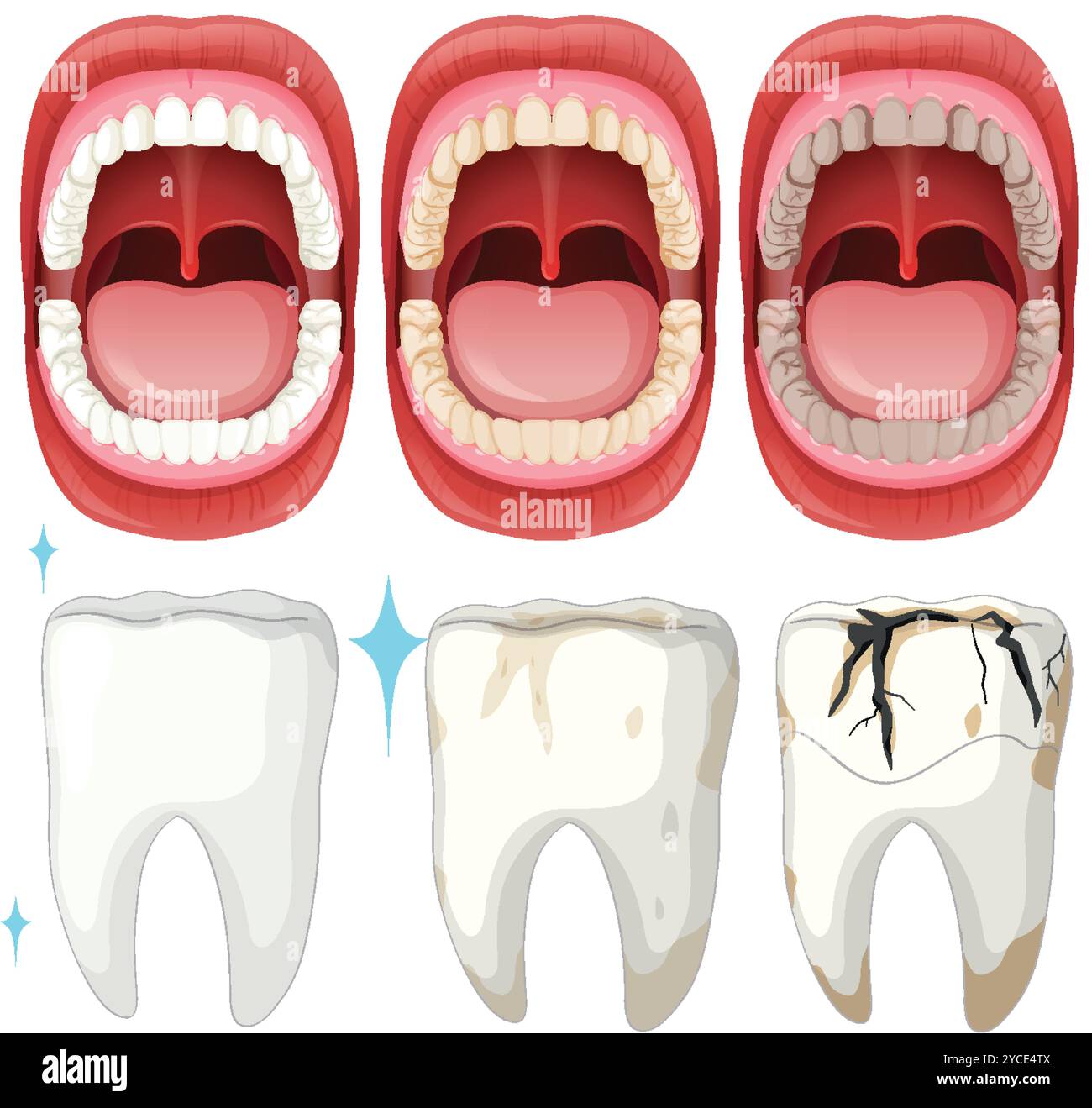 Illustration showing healthy and decayed teeth stages Stock Vector ...