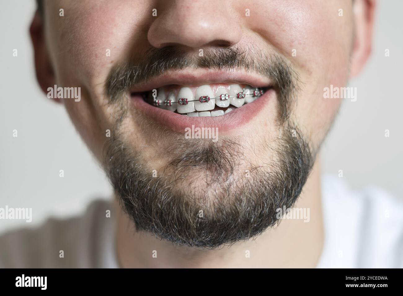 Close up of a young man with braces smiling. Macro shot of a young man ...