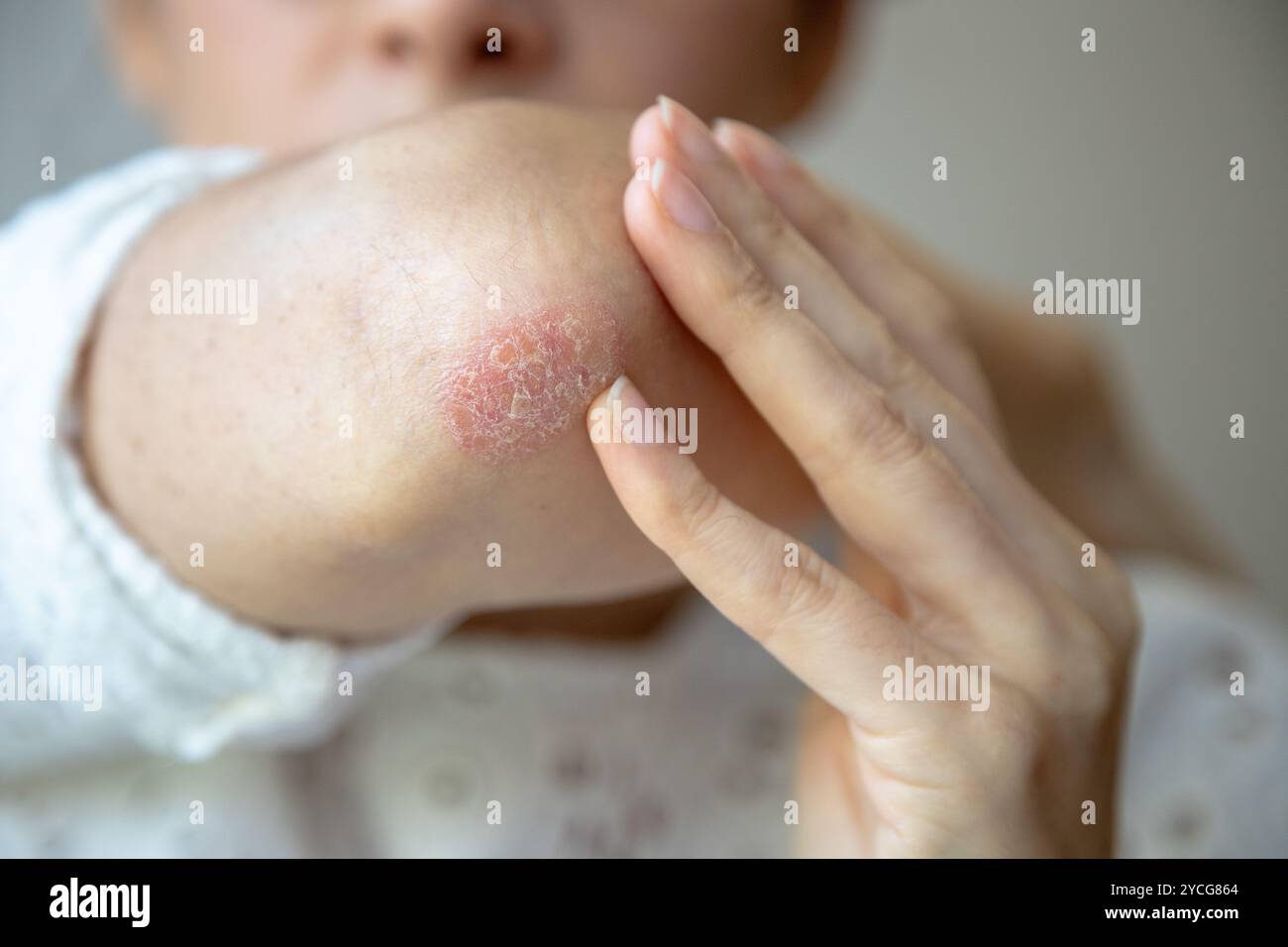 Skin rash on elbow hi-res stock photography and images - Alamy
