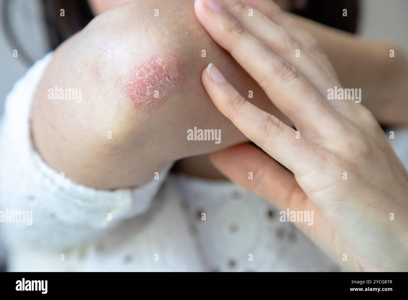 Skin rash on elbow hi-res stock photography and images - Alamy