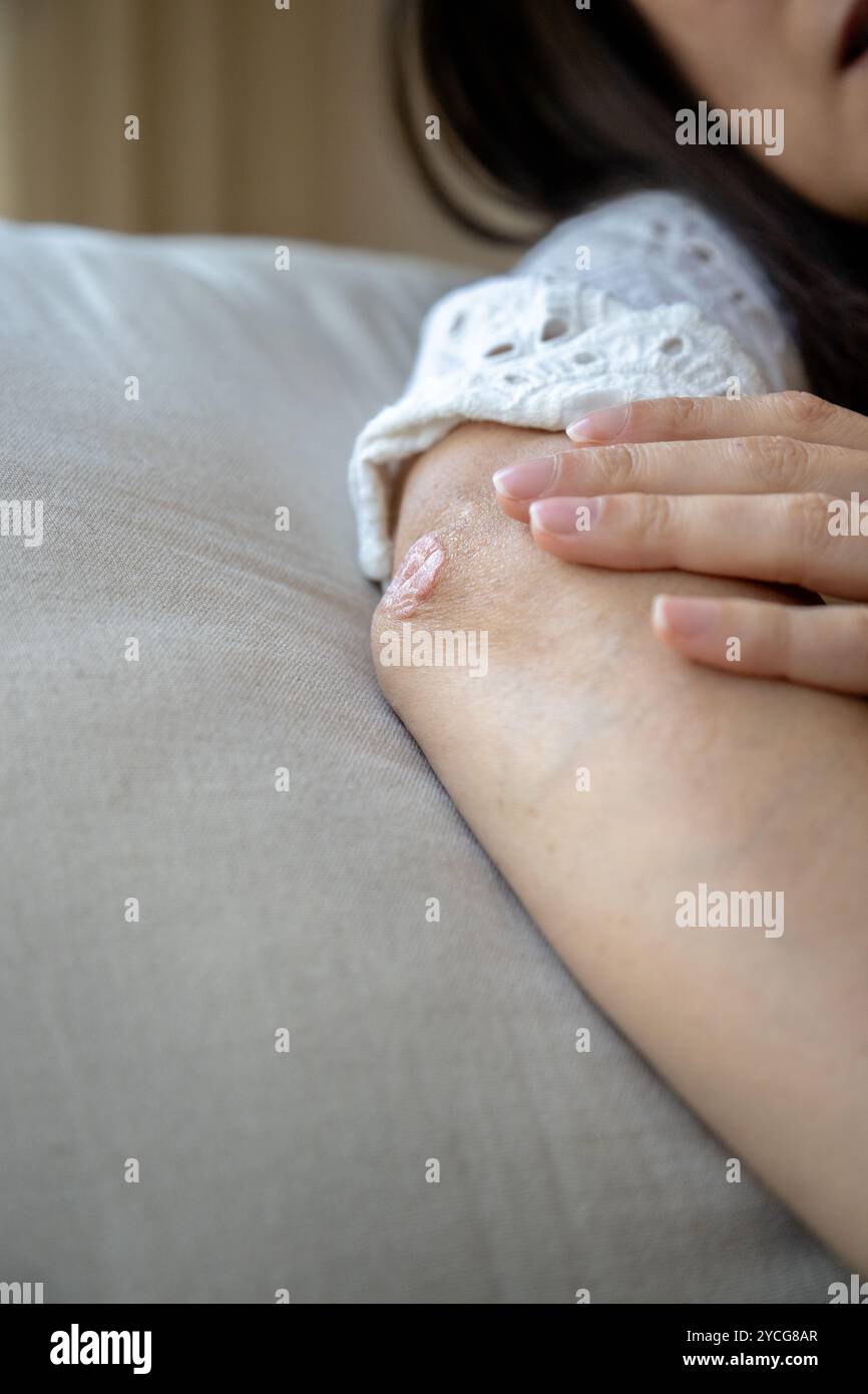 Skin rash on elbow hi-res stock photography and images - Alamy