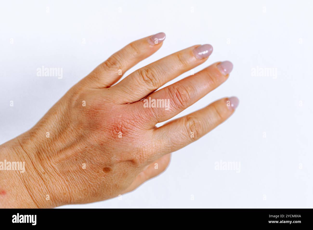 Swollen hand from allergic hi-res stock photography and images - Alamy