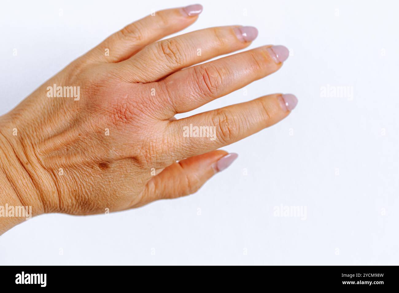 Swollen hand bite hi-res stock photography and images - Alamy