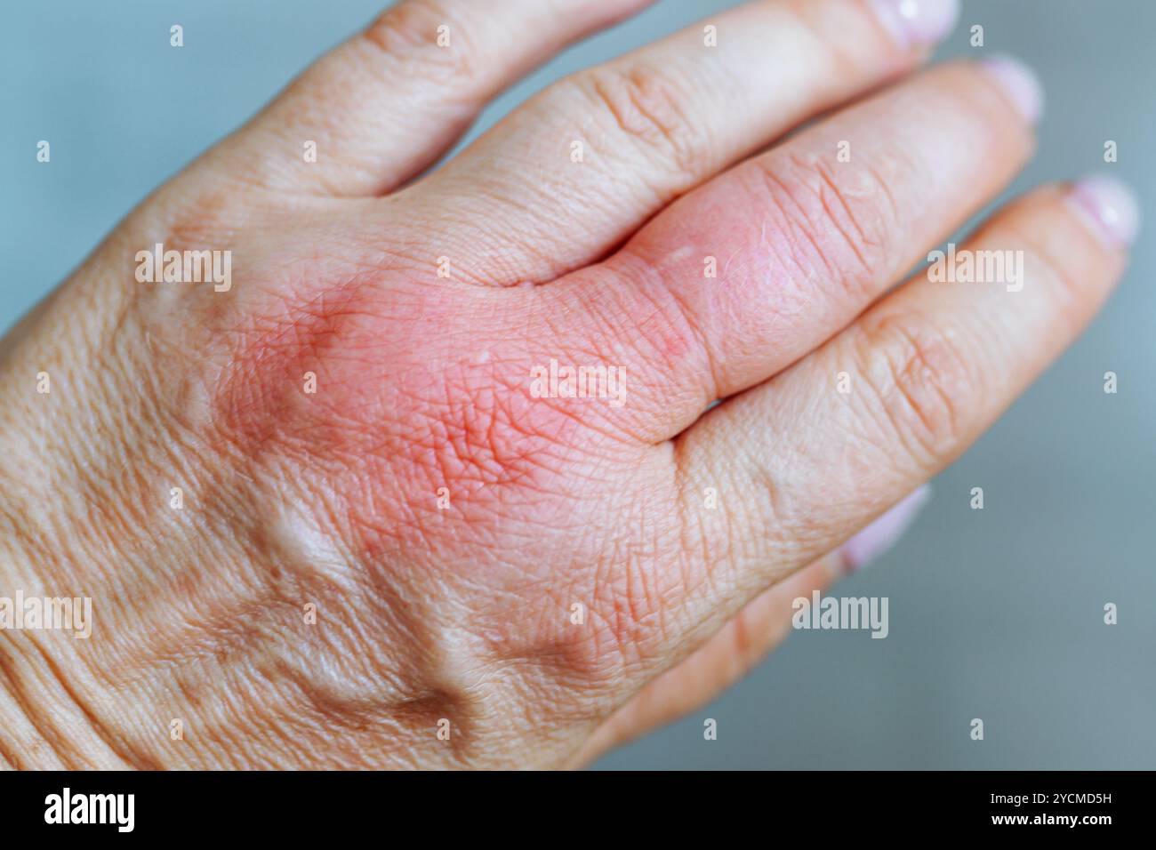 female hand with pigment spots on skin, swollen finger from insect bite ...