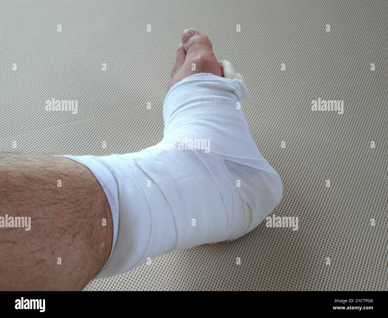Ankle fracture cast Stock Photo - Alamy