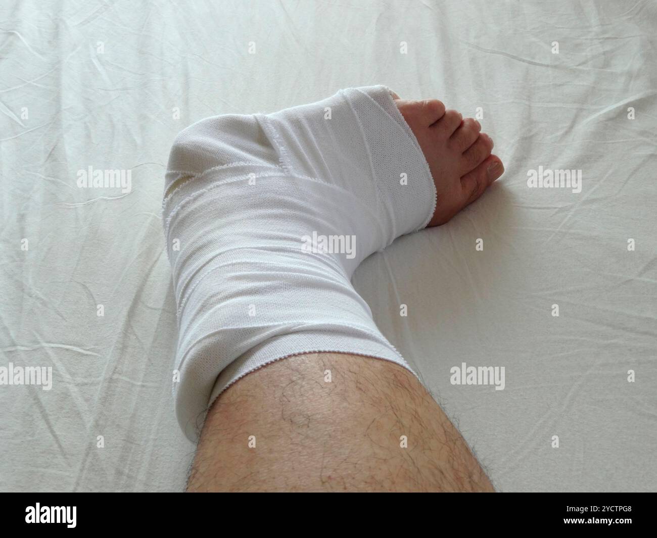 Ankle fracture cast Stock Photo - Alamy
