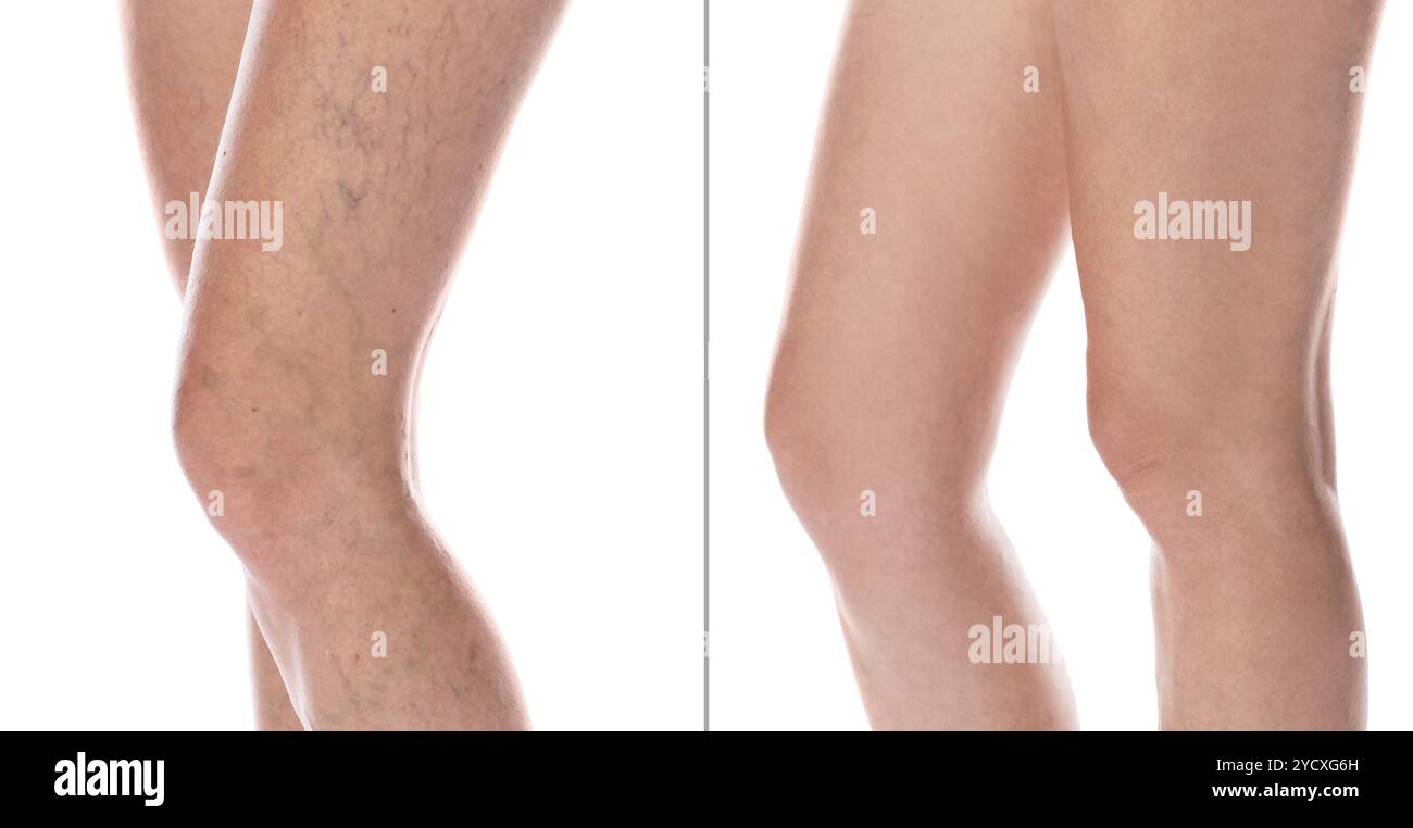 Varicose veins treatment. Woman showing legs on white background ...