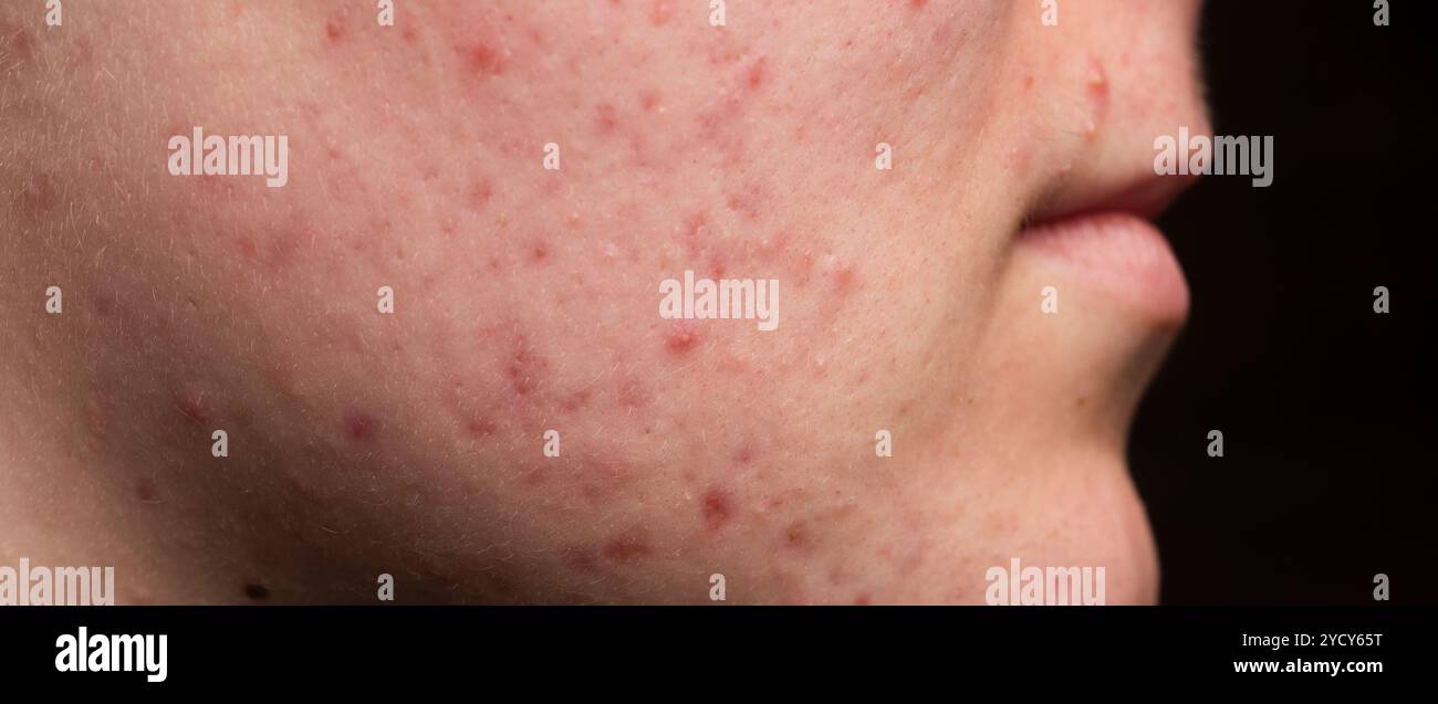 Skin texture background. Closeup acne pimple. Treatment for skin ...