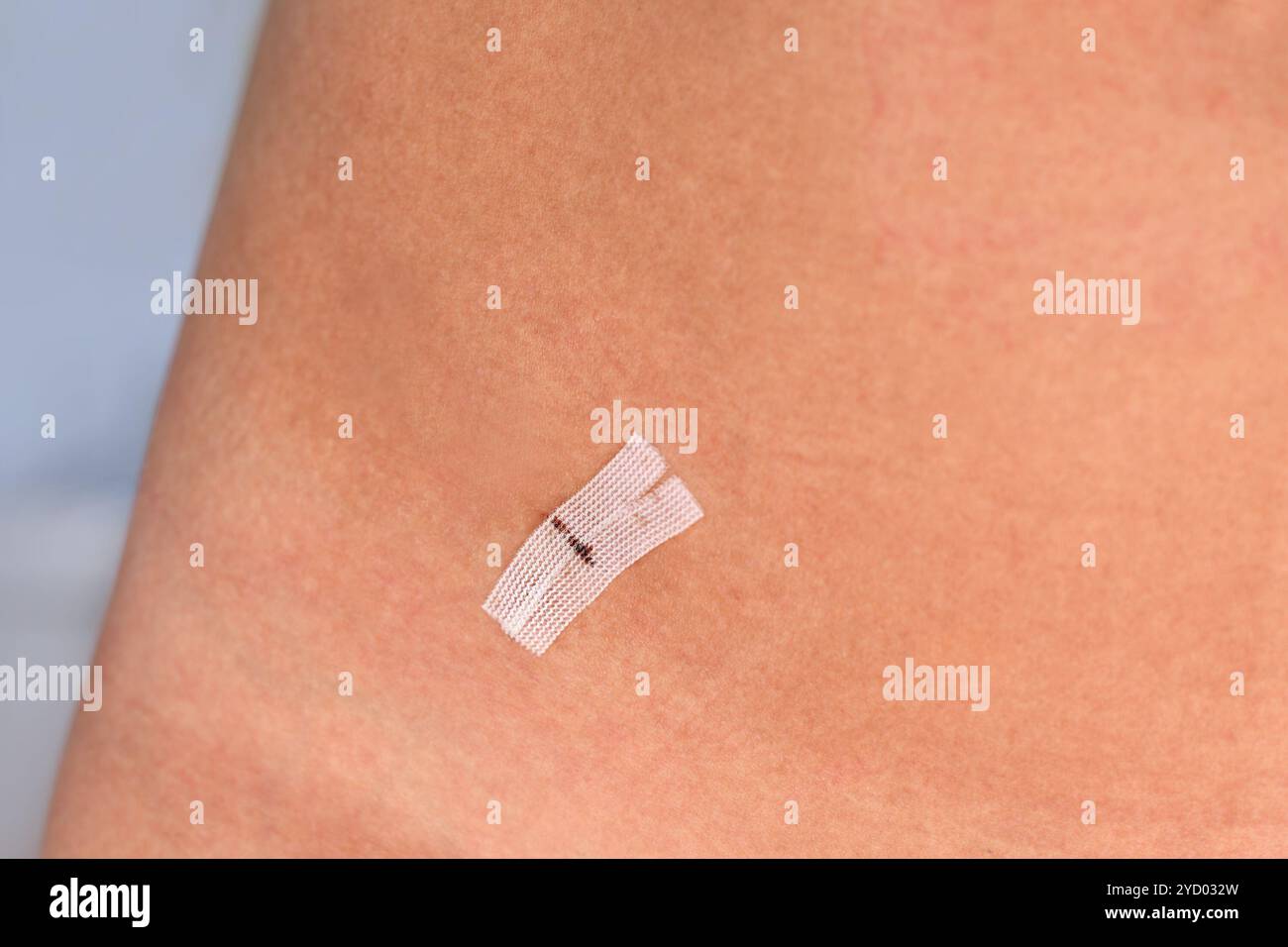 Sterile wound closure strip used on cut after laparoscopy on woman's ...