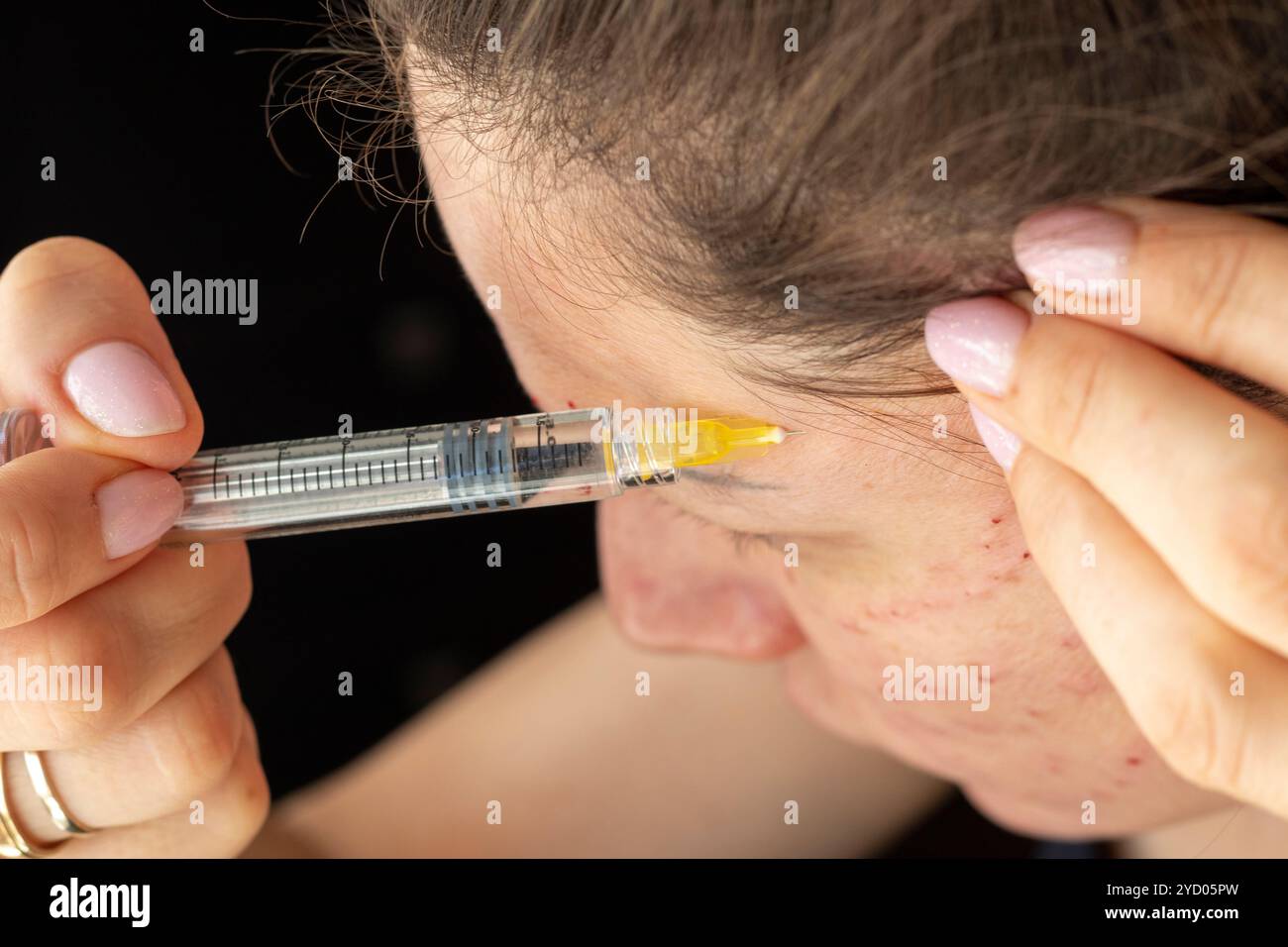 Woman performing mesotherapy, bio revitalization procedure, injecting ...