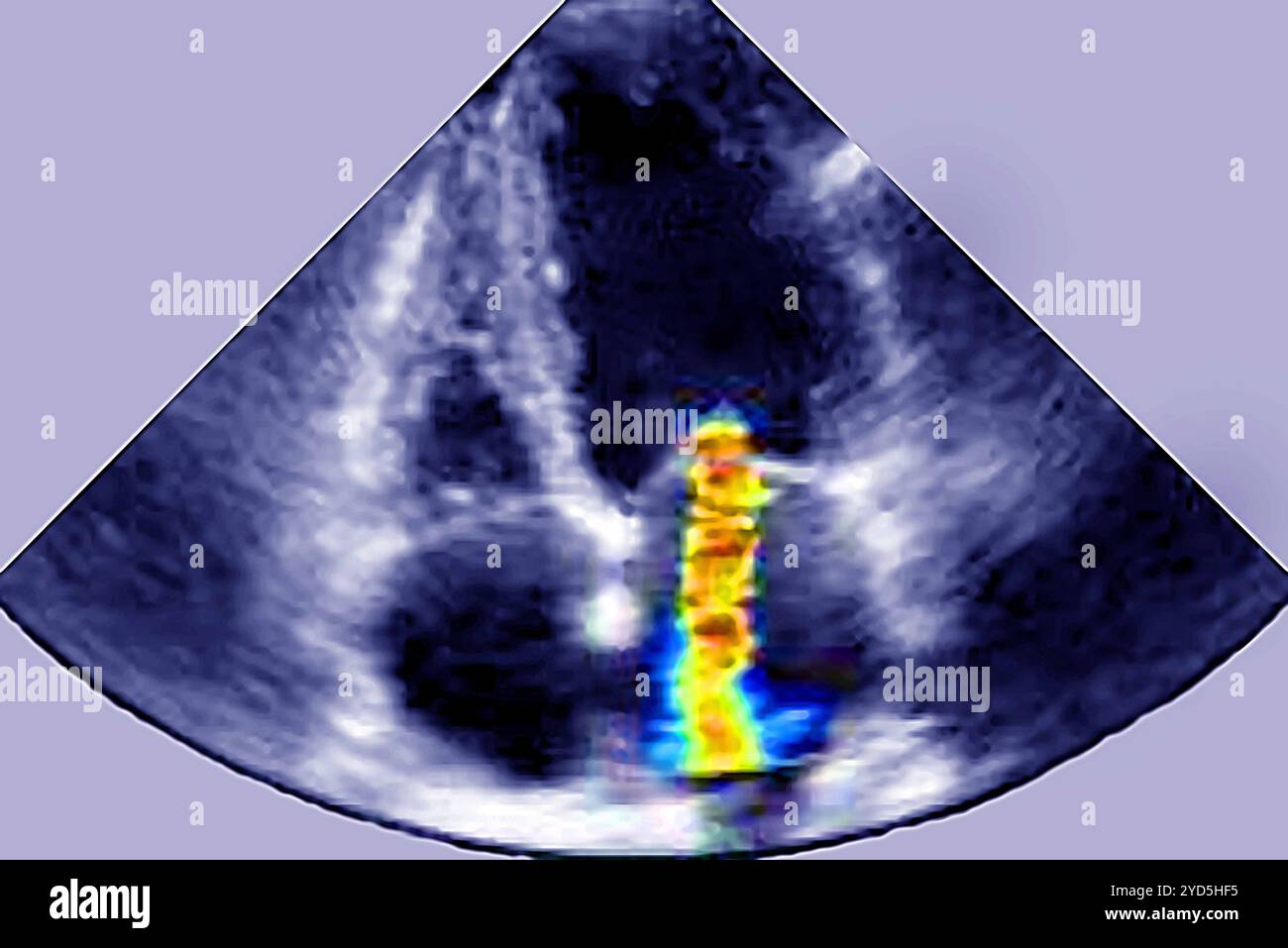 Ischemic mitral insufficiency (MI) - Pathology of the left ventricle ...