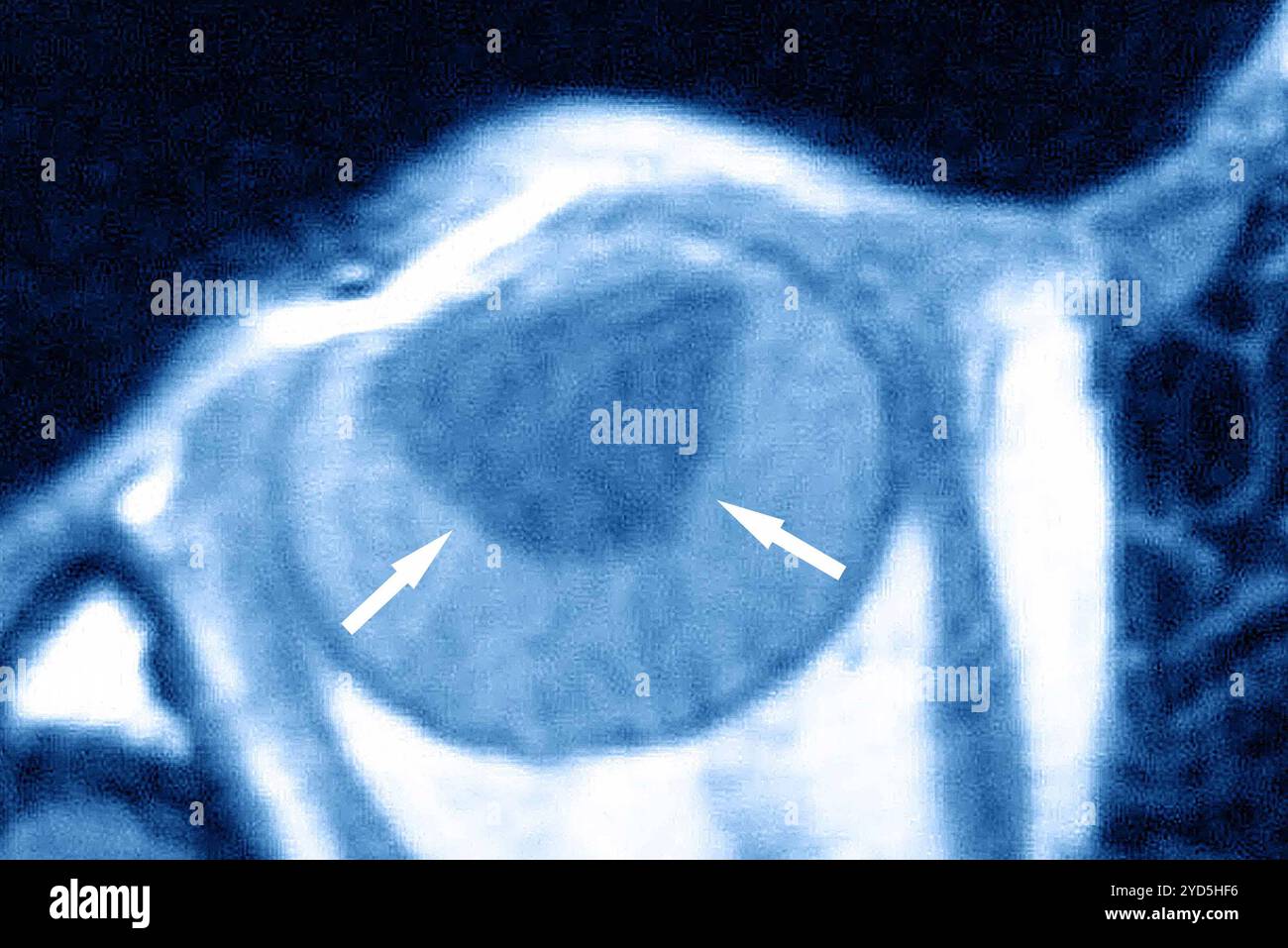 Retinal detachment occurs when the tissue at the back of the eye ...