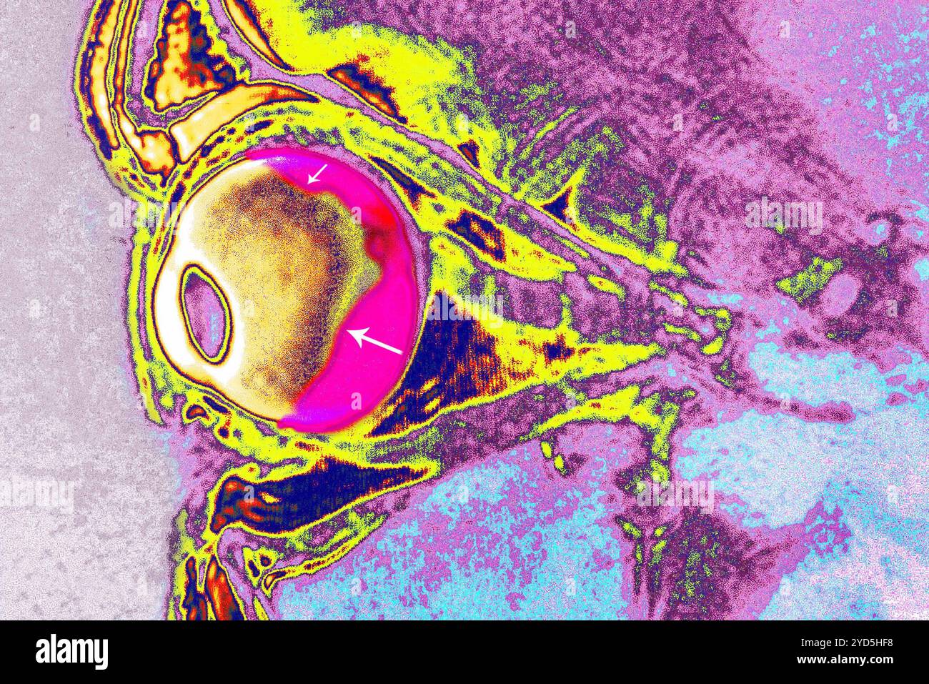 Retinal detachment occurs when the tissue at the back of the eye ...