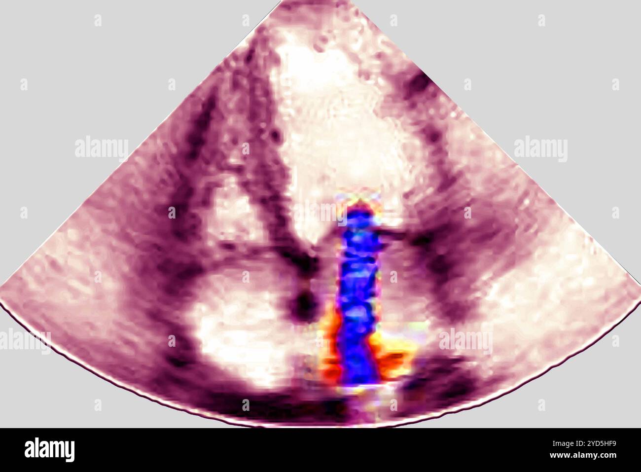 Ischemic Mitral Insufficiency Mi Pathology Of The Left Ventricle