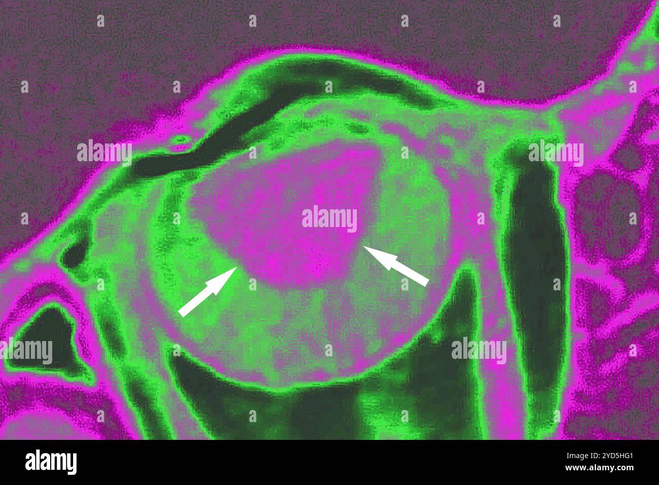 Retinal detachment occurs when the tissue at the back of the eye ...