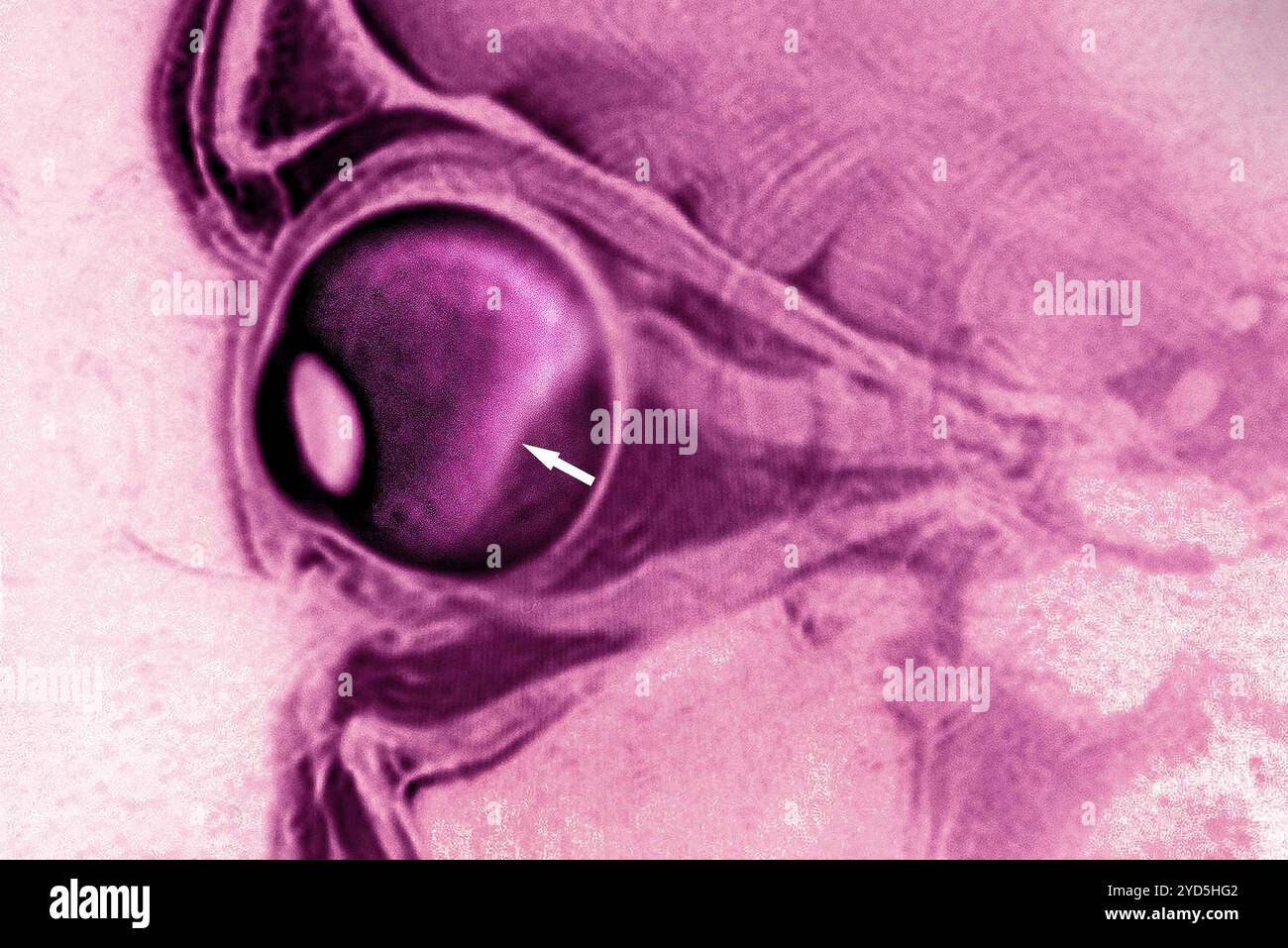 Retinal detachment occurs when the tissue at the back of the eye ...