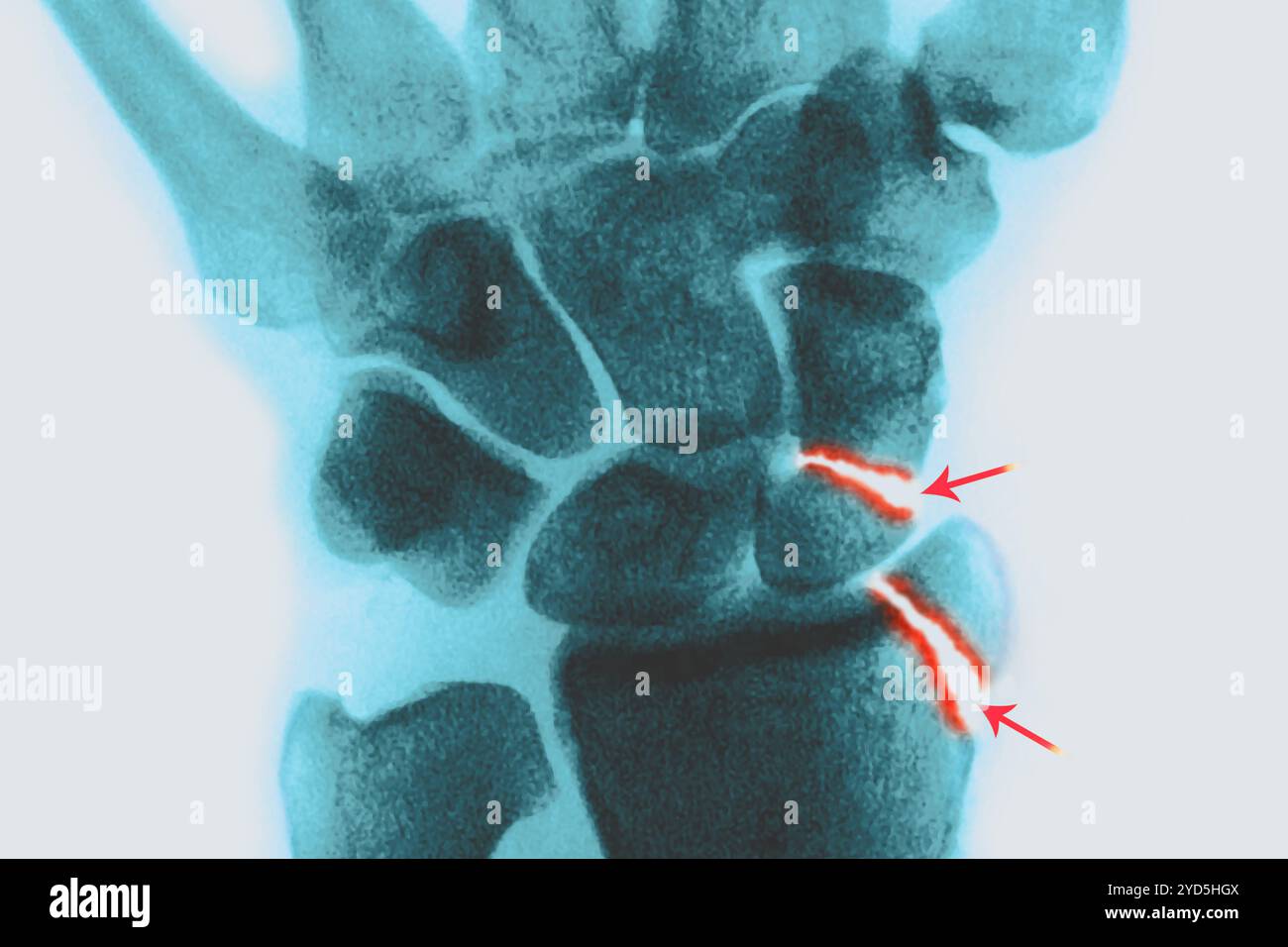 Wrist fracture (scaphoid and radius). X-ray of the wrist of a right ...
