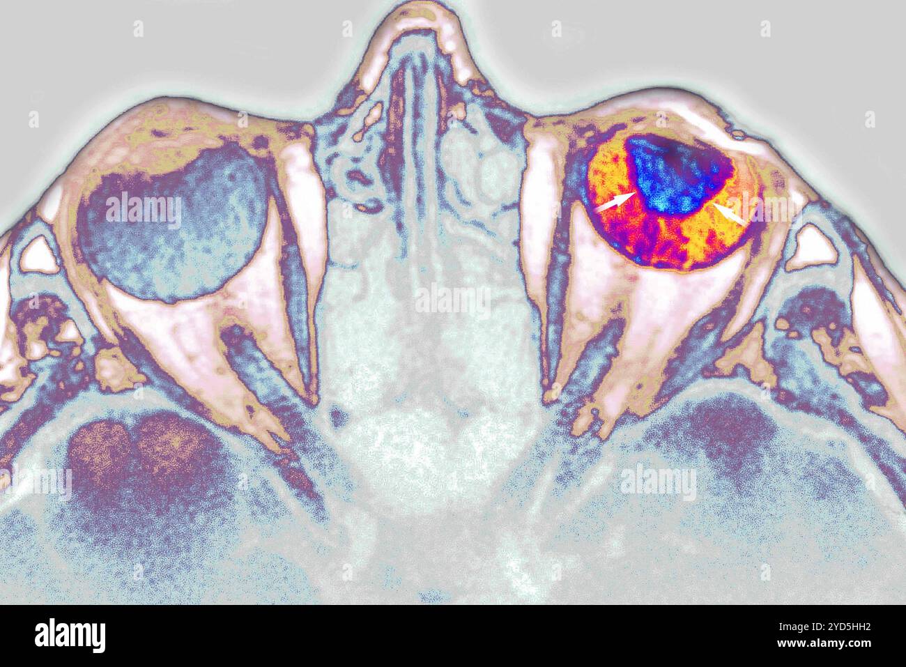 Retinal detachment occurs when the tissue at the back of the eye ...