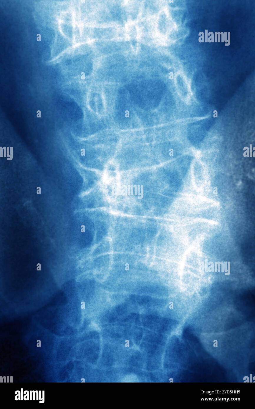 Lumbar osteoporosis (disease causing compression and fractures of the ...