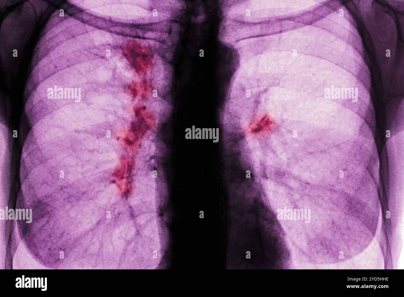 Right and left lung cancer (stage 1). Front chest x-ray Stock Photo - Alamy