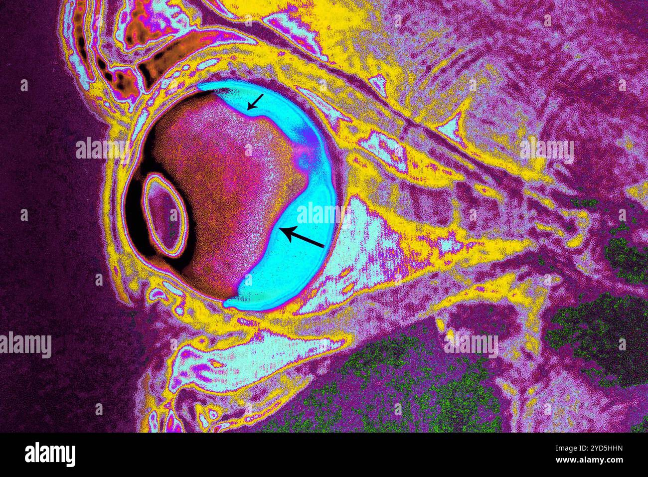 Retinal detachment occurs when the tissue at the back of the eye ...