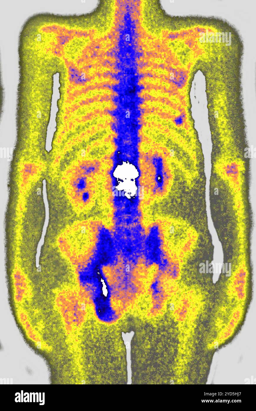 Lumbar osteoporosis (disease causing compression and fractures of the ...