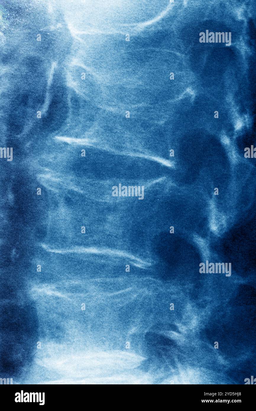 Lumbar osteoporosis (disease causing compression and fractures of the ...