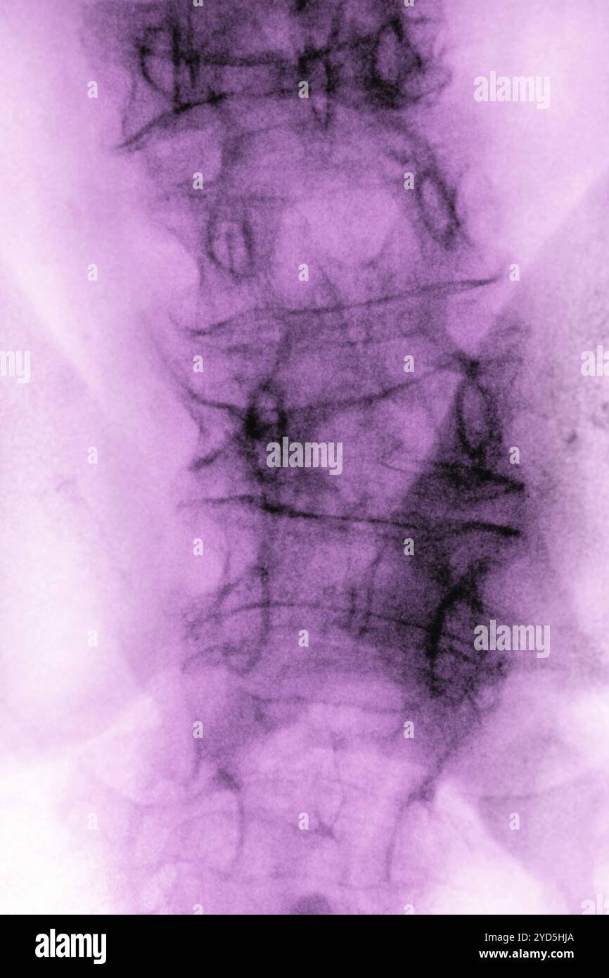 Lumbar osteoporosis (disease causing compression and fractures of the ...