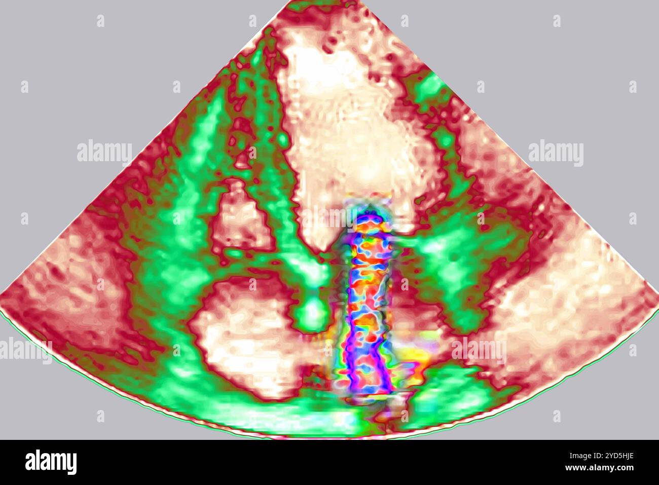 Ischemic mitral insufficiency (MI) - Pathology of the left ventricle ...