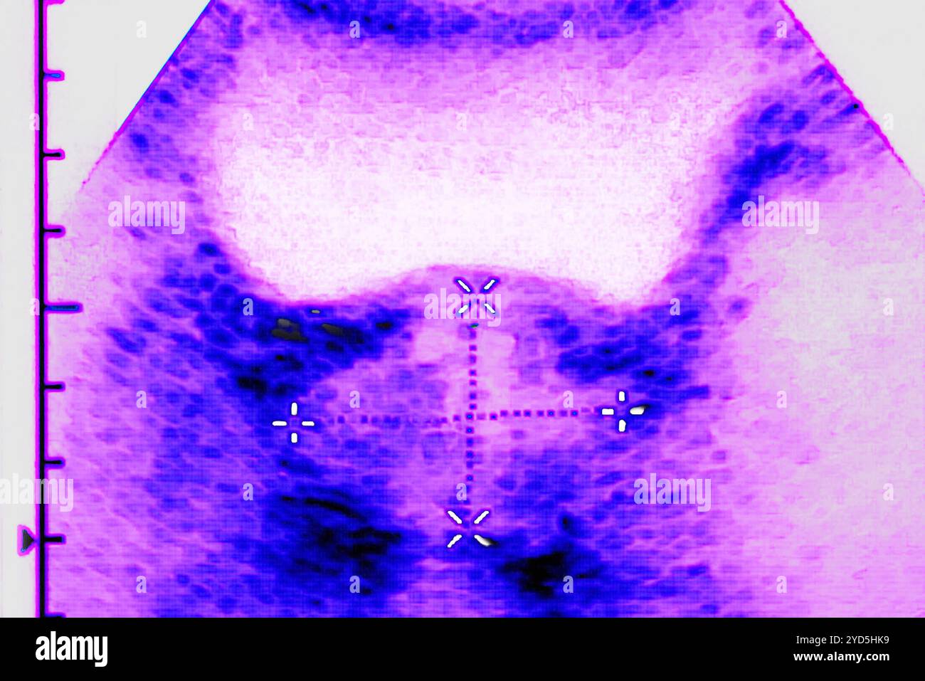 Prostate and bladder control examination with measurements of the ...