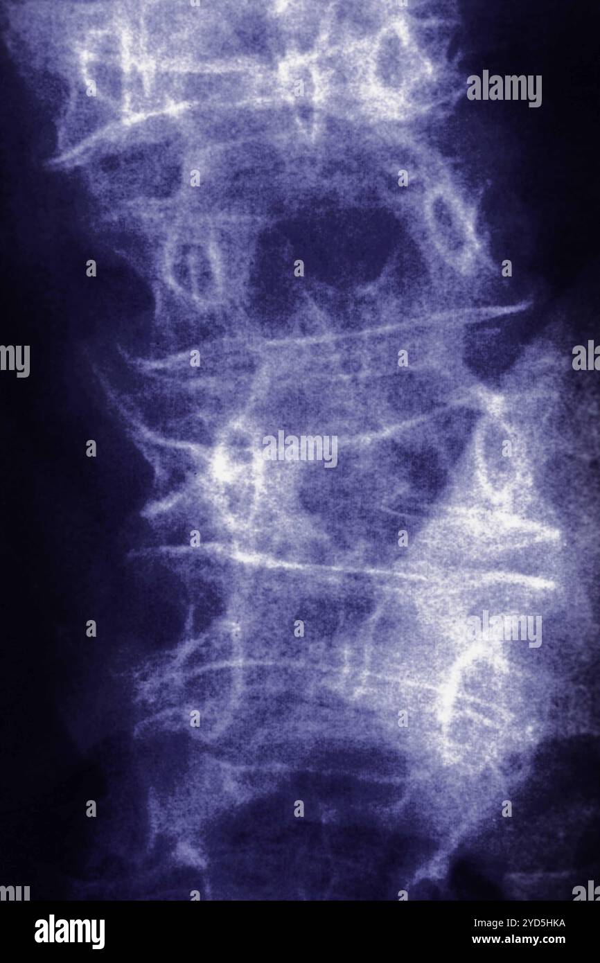 Lumbar osteoporosis (disease causing compression and fractures of the ...