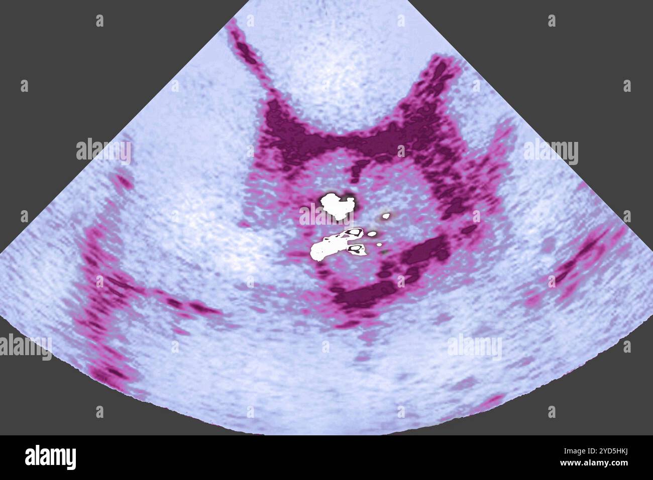 Calcified heart valve disease. The tricuspid valve separates the right ...