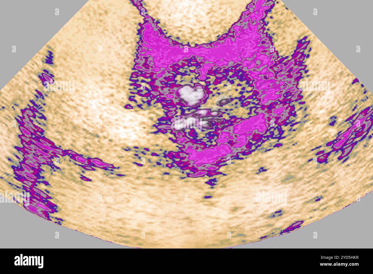 Calcified heart valve disease. The tricuspid valve separates the right ...