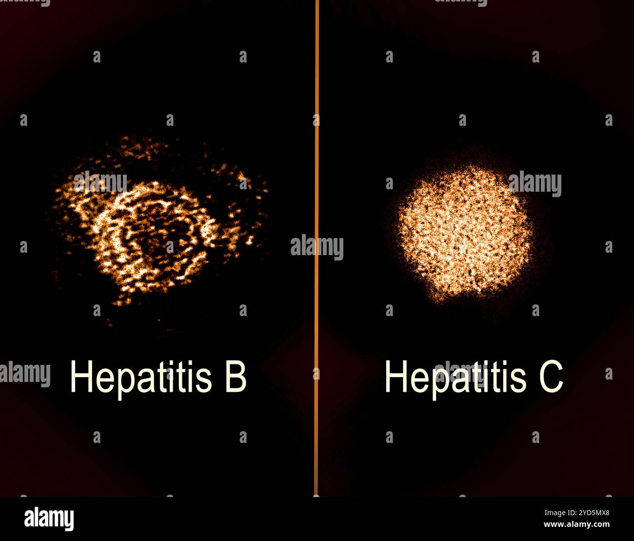 Side-by-side transmission electron micrograph images of hepatitis B and ...