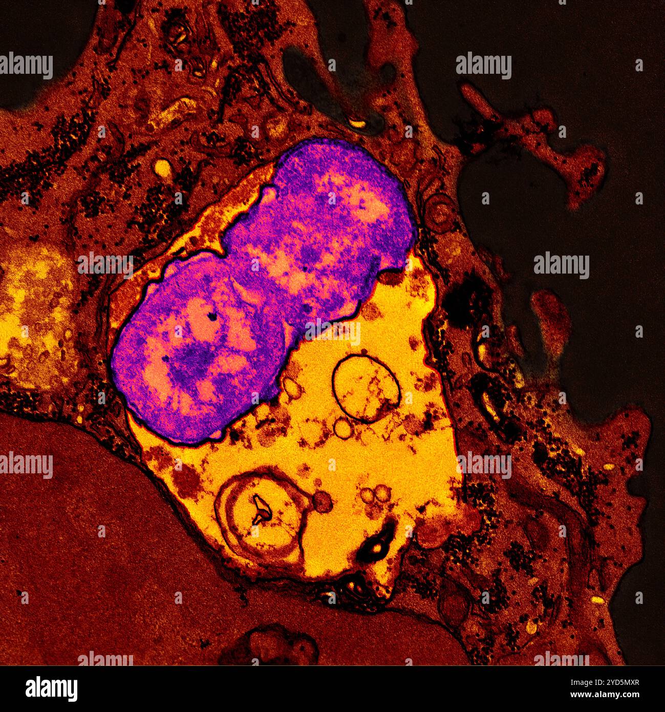 A human neutrophil (red) containing ingested Klebsiella pneumoniae ...