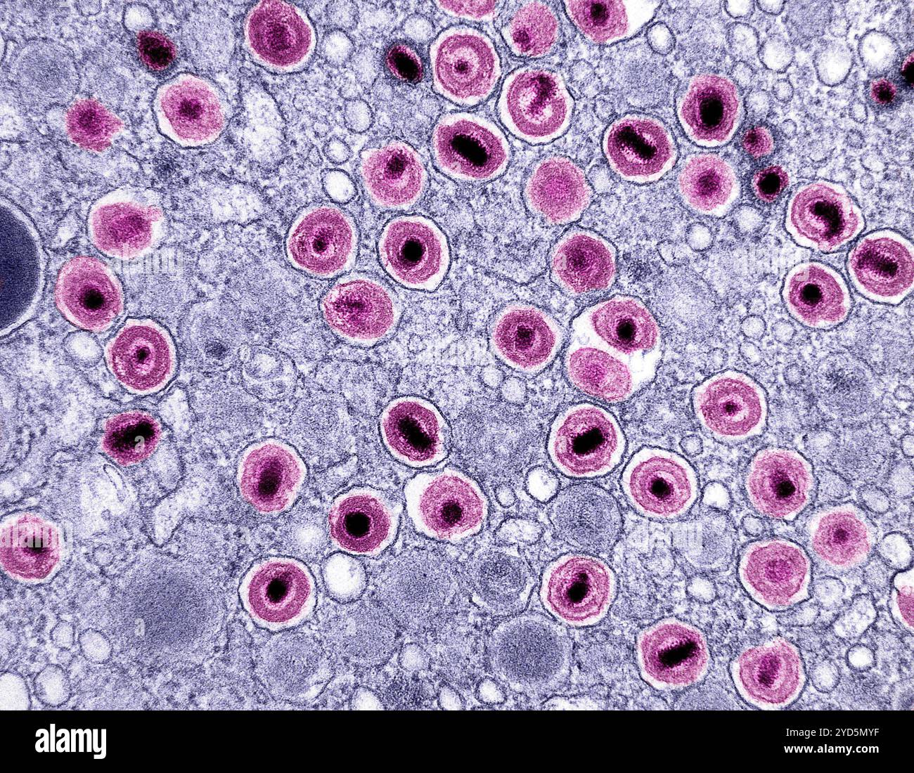 Transmission electron micrograph of cytomegalovirus (CMV) particles ...