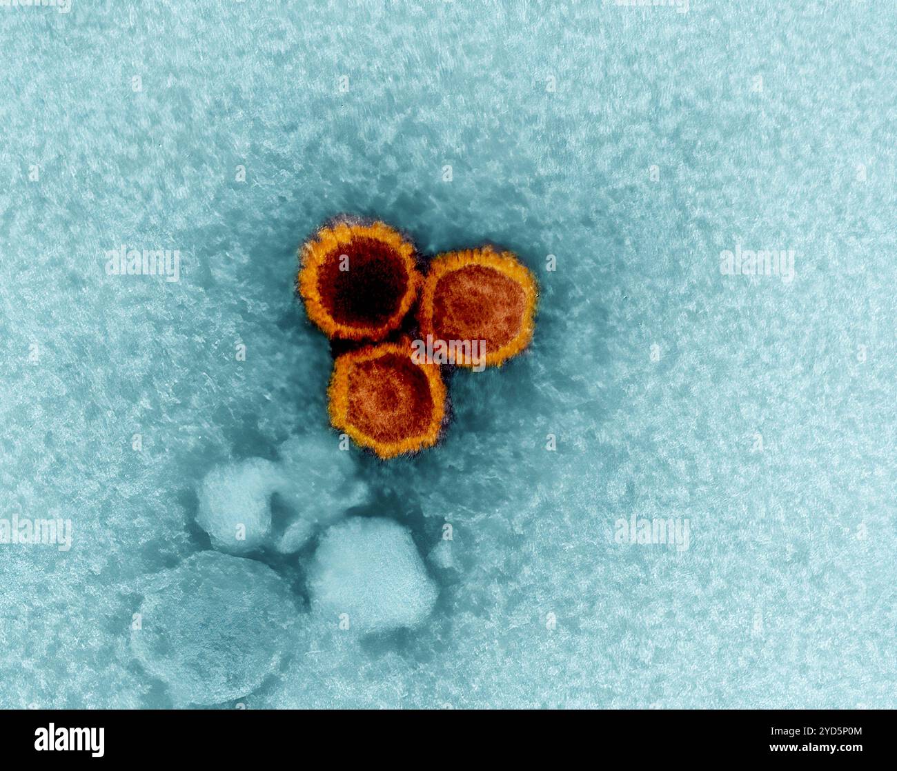 An electron micrograph showing three Epstein-Barr virus (EBV) particles ...