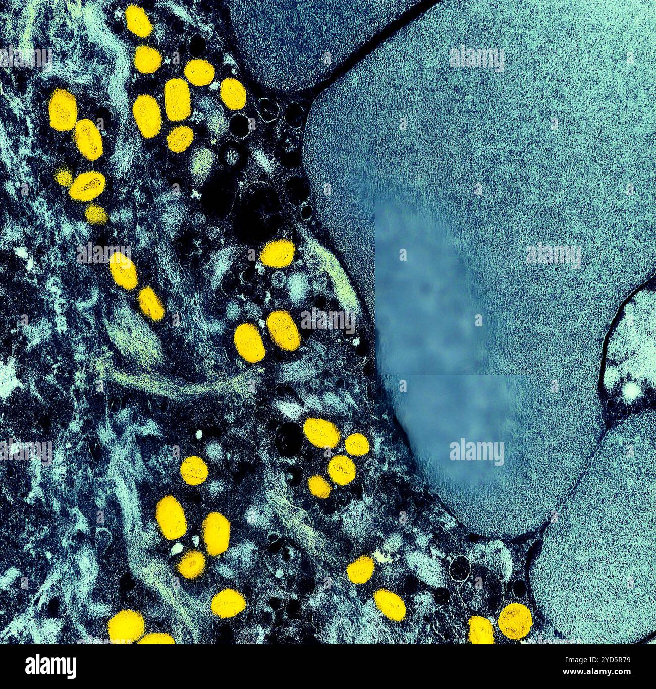 Colorized Transmission Electron Micrograph Of Mpox Virus Particles