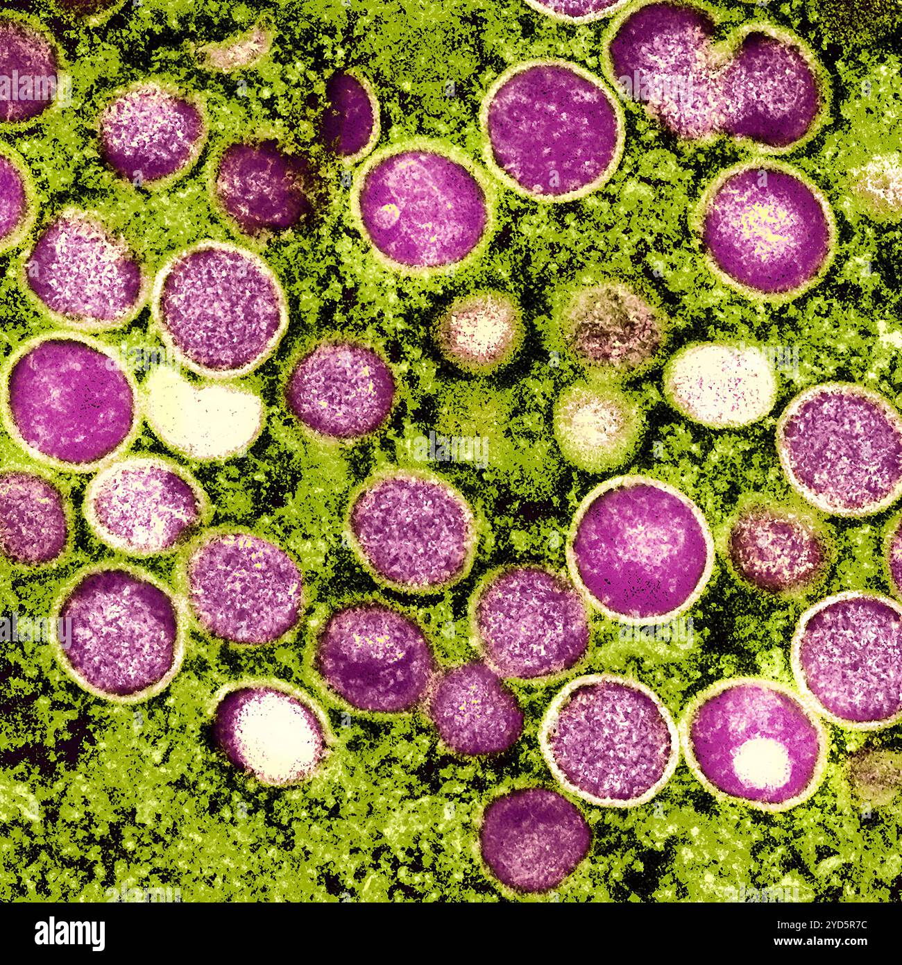 Colorized transmission electron micrograph of mpox virus particles ...