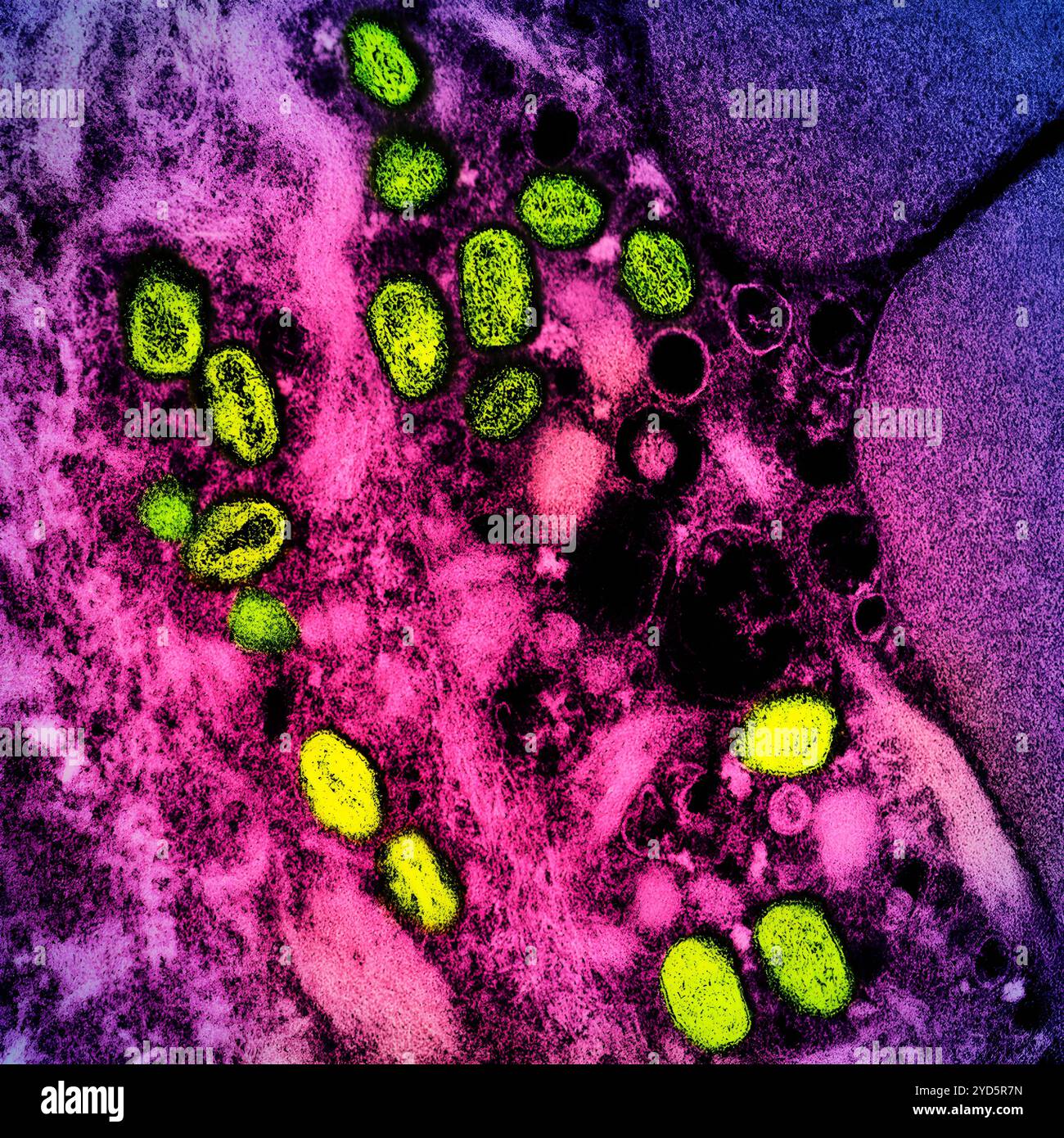 Colorized transmission electron micrograph of mpox virus particles ...