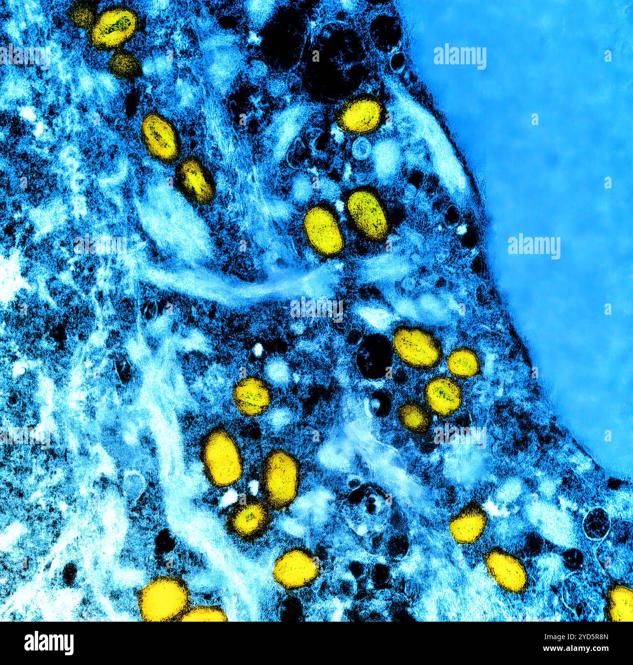 Colorized Transmission Electron Micrograph Of Mpox Virus Particles