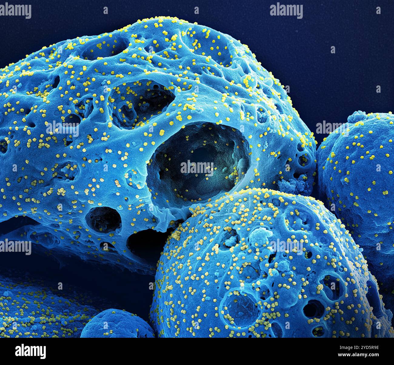 Colorized scanning electron micrograph of a cell (blue) infected with ...
