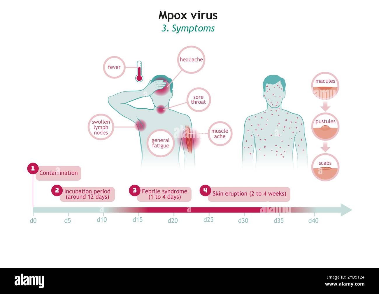 Mpox virus symptoms Stock Photo - Alamy
