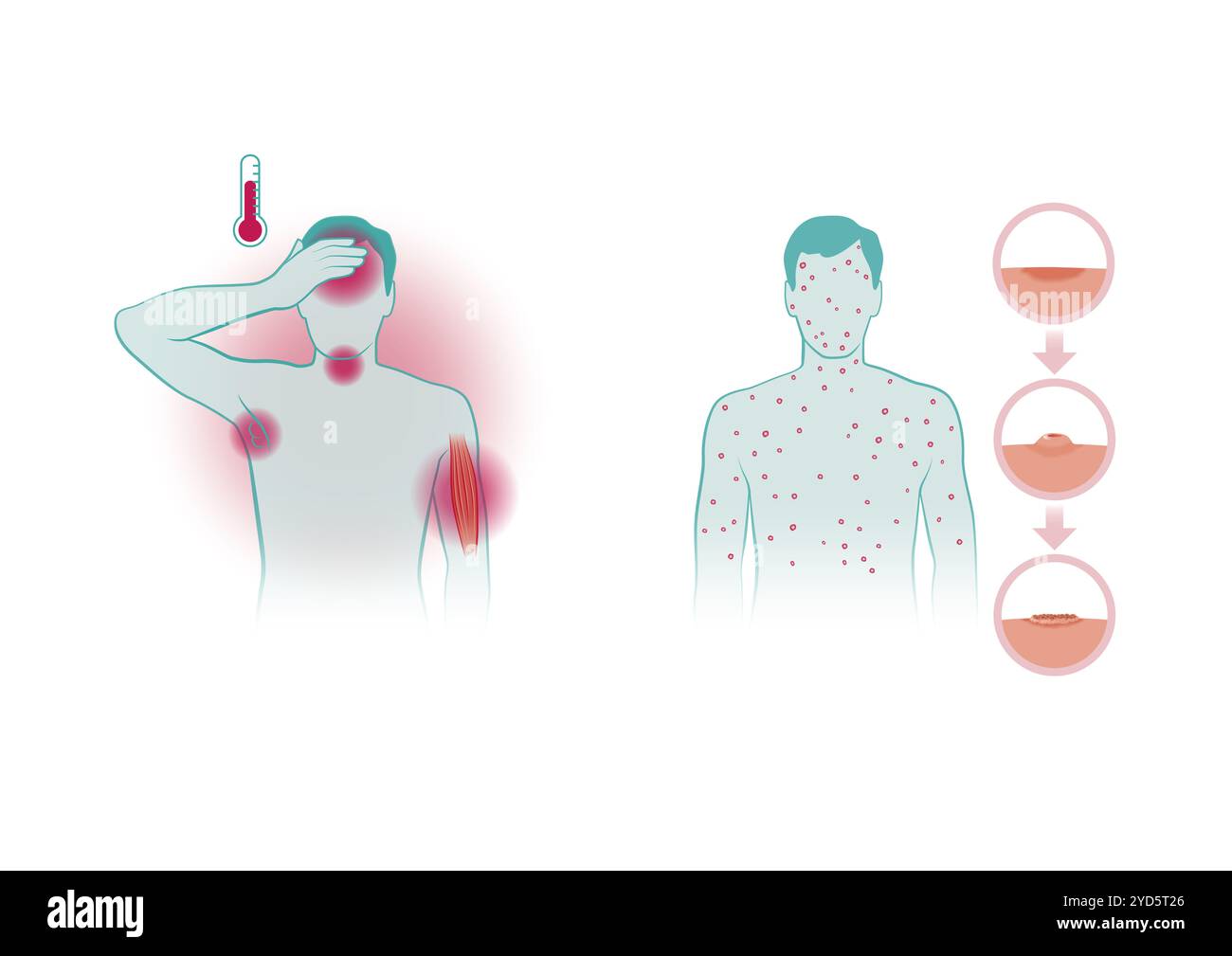 Symptoms of Mpox virus Stock Photo - Alamy