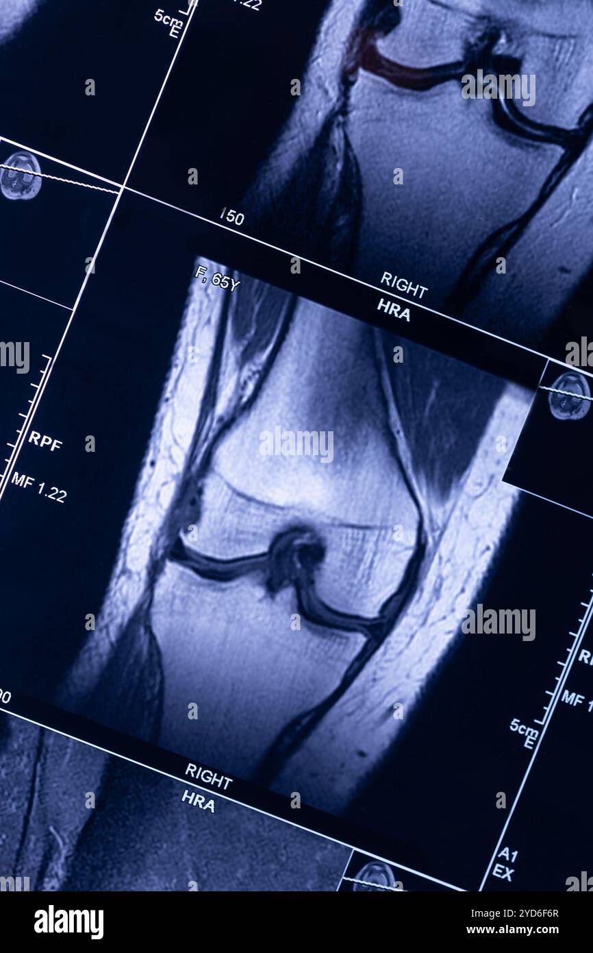 Xray MRI examination magnetic resonance images showing real knee blue ...