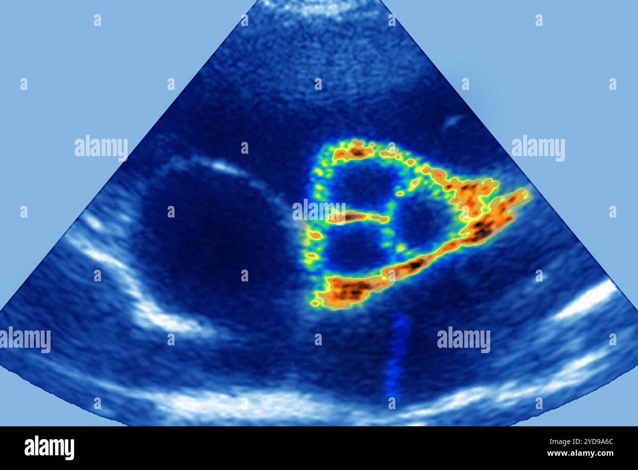 Tricuspid valve, it separates the right atrium and ventricle. It is ...
