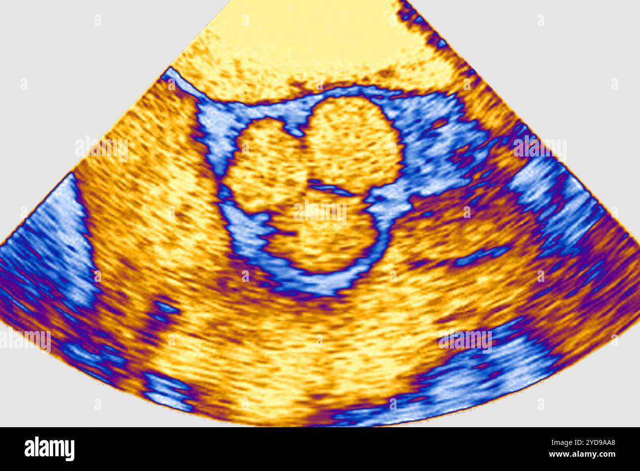 Tricuspid valve, it separates the right atrium and ventricle. It is ...